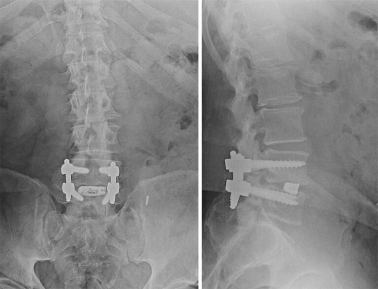 Spinal Fusion Manhattan NYC Long Island